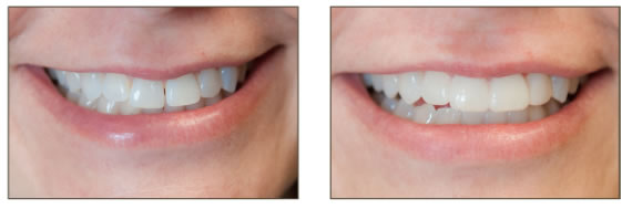 Seeing Is Believing: What Is a Trial Smile and How It Works